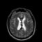 Intraventricular cavernoma