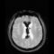 Intraventricular cavernoma