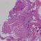 Intraventricular cavernoma