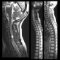 Diffusion imaging in the spine
