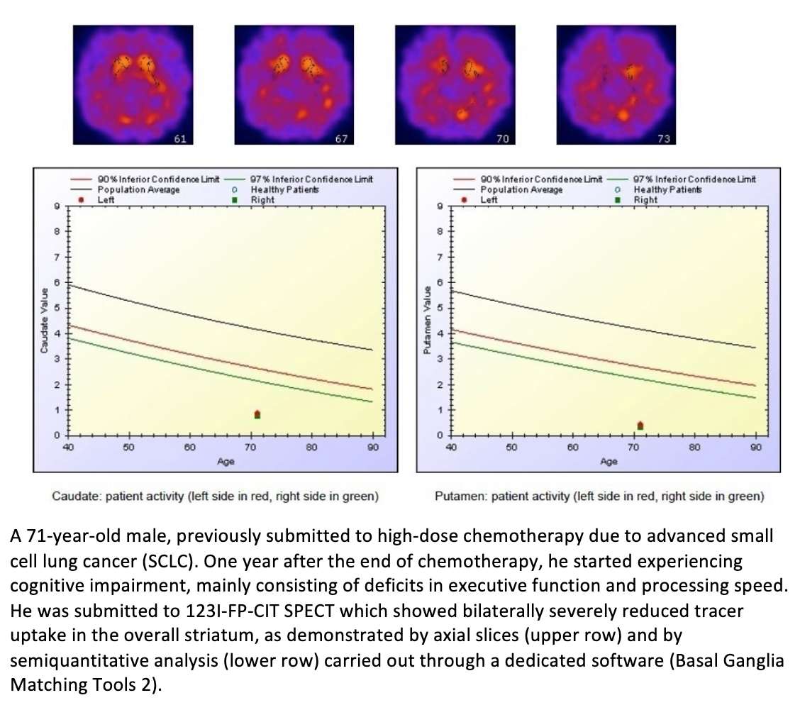 Nuclear Medicine Evaluates Biological Changes That Cause Chemo-Brain ...