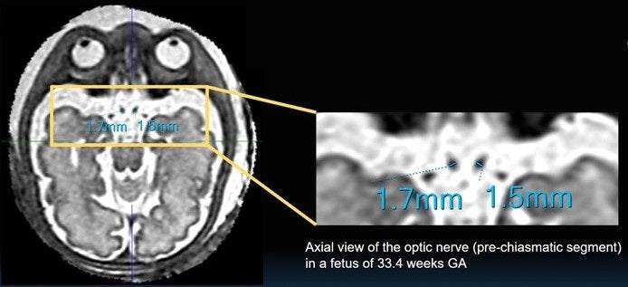 3D SVR MRI Enables Delineation, Measurement of Fetal Optic Pathway ...