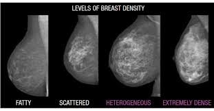 Breast Density Changes Over Time Linked to Cancer Risk | Applied Radiology