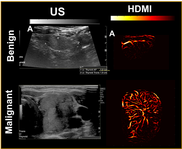 Advanced Ultrasound Paired With AI Diagnoses Thyroid Cancers | Applied ...