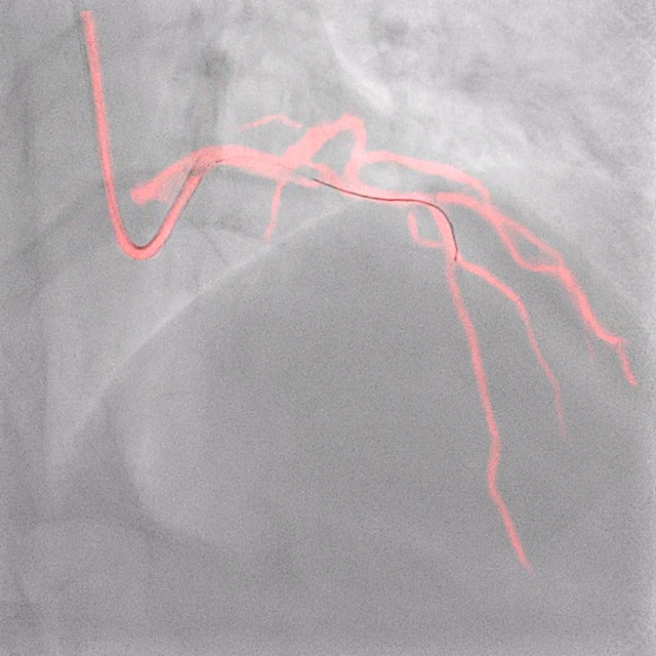 AI-Based Technology for Analyzing Coronary Angiography Enhances ...