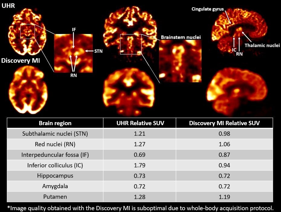Brain Stem Nuclei Visualized, Quantified for First Time With Ultra-High ...