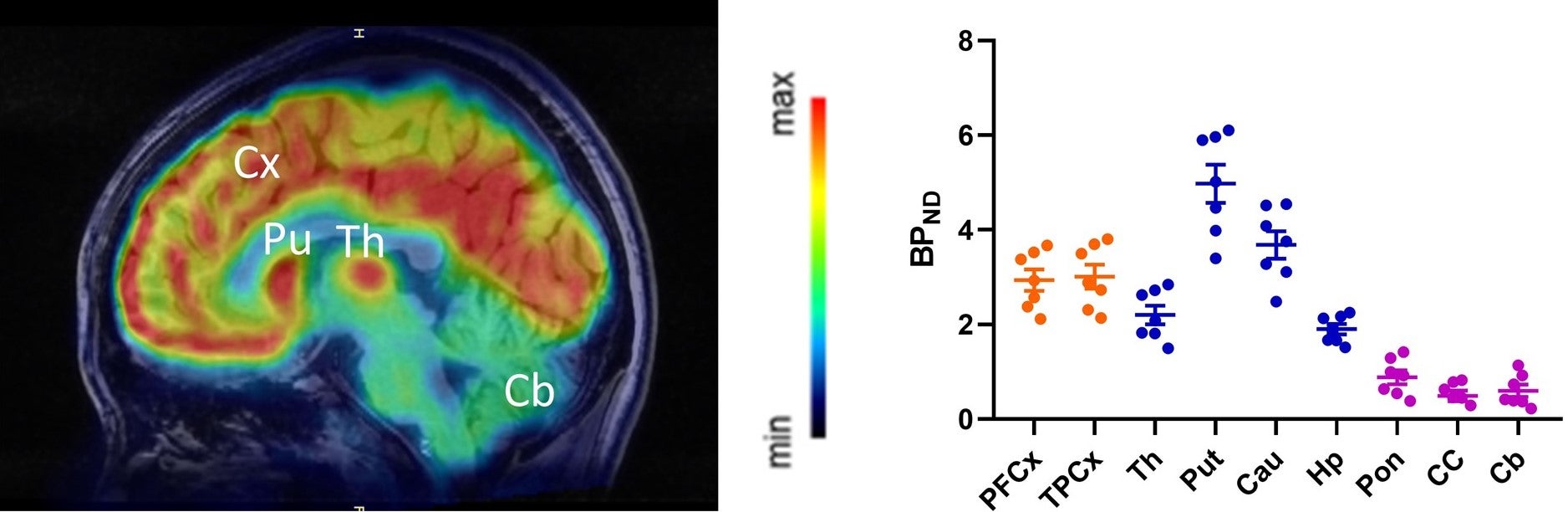 Brain Cholesterol Metabolism Visualized With New PET Radiotracer ...