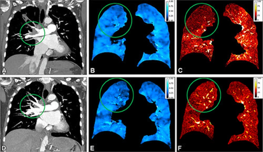 Photon-Counting CT Delivers Simultaneous Evaluation of Lung Structure ...
