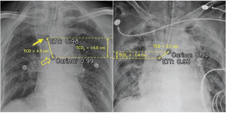AI Identifies Improperly Positioned Endotracheal Tube Using Chest ...