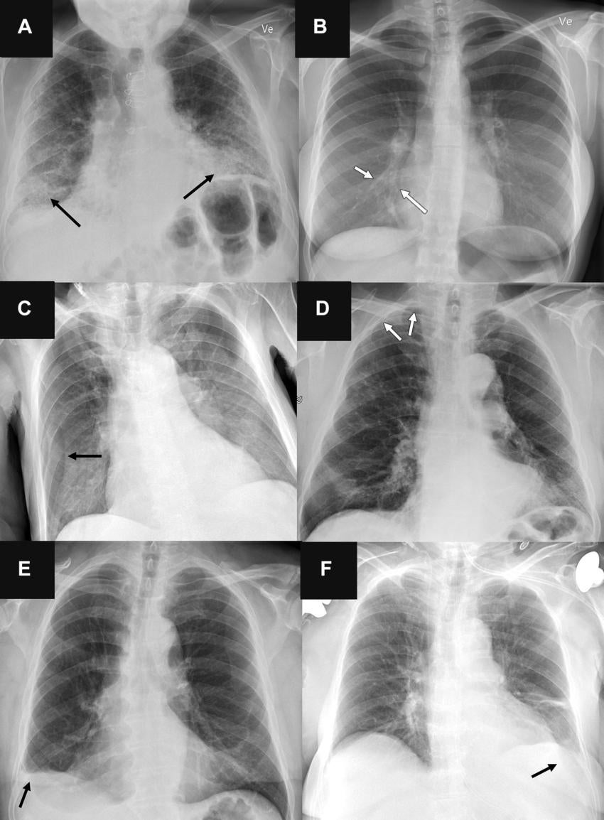 Radiologists Outperform AI in Detecting Lung Diseases With Chest X-ray ...