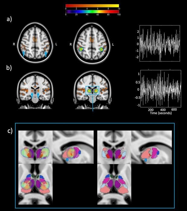 7T MRI Provides Insight Into How Light Stimulates the Brain | Applied ...