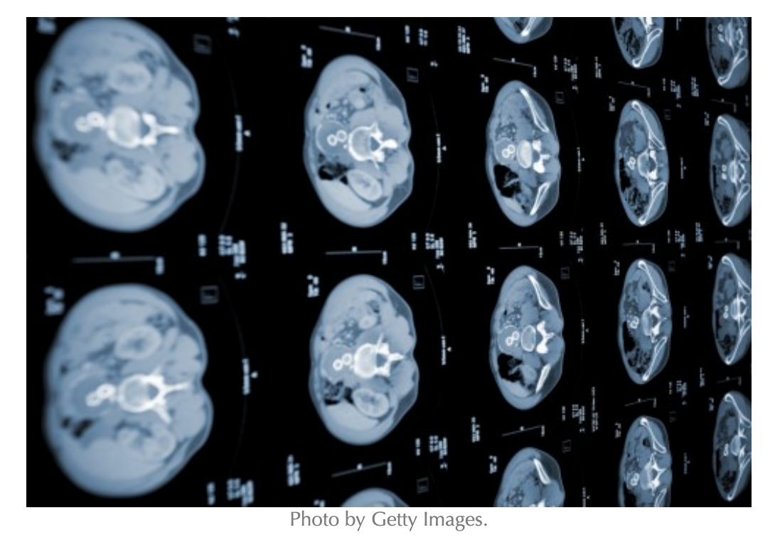 RSNA Margulis Award Honors AI Tool for Pancreatic Cancer Detection ...