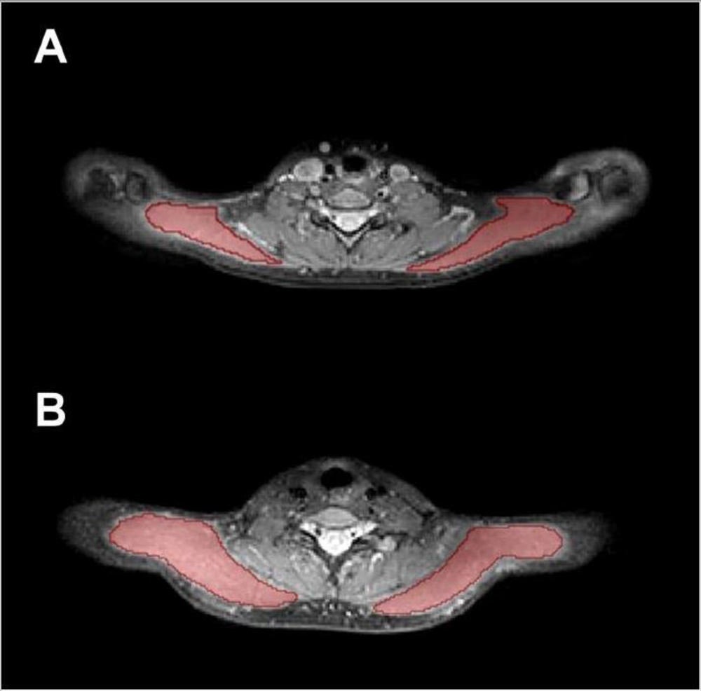 Neck Inflammation Involved in Common Headaches | Applied Radiology