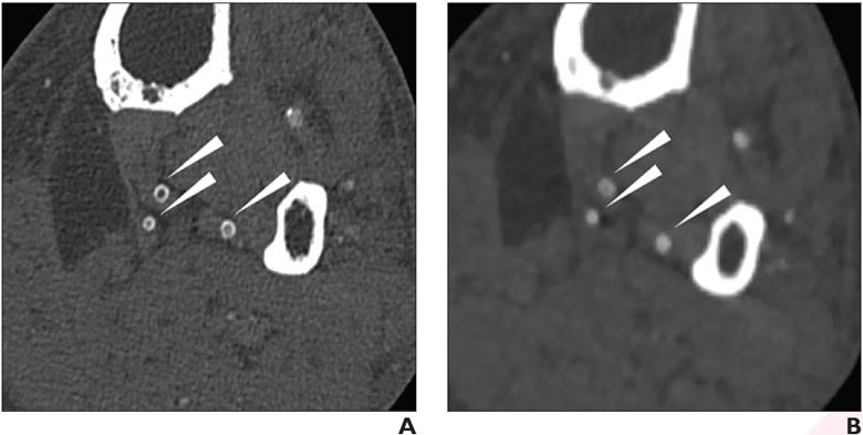 Photon-Counting Detector CT Improves Vascular Evaluation in Peripheral ...