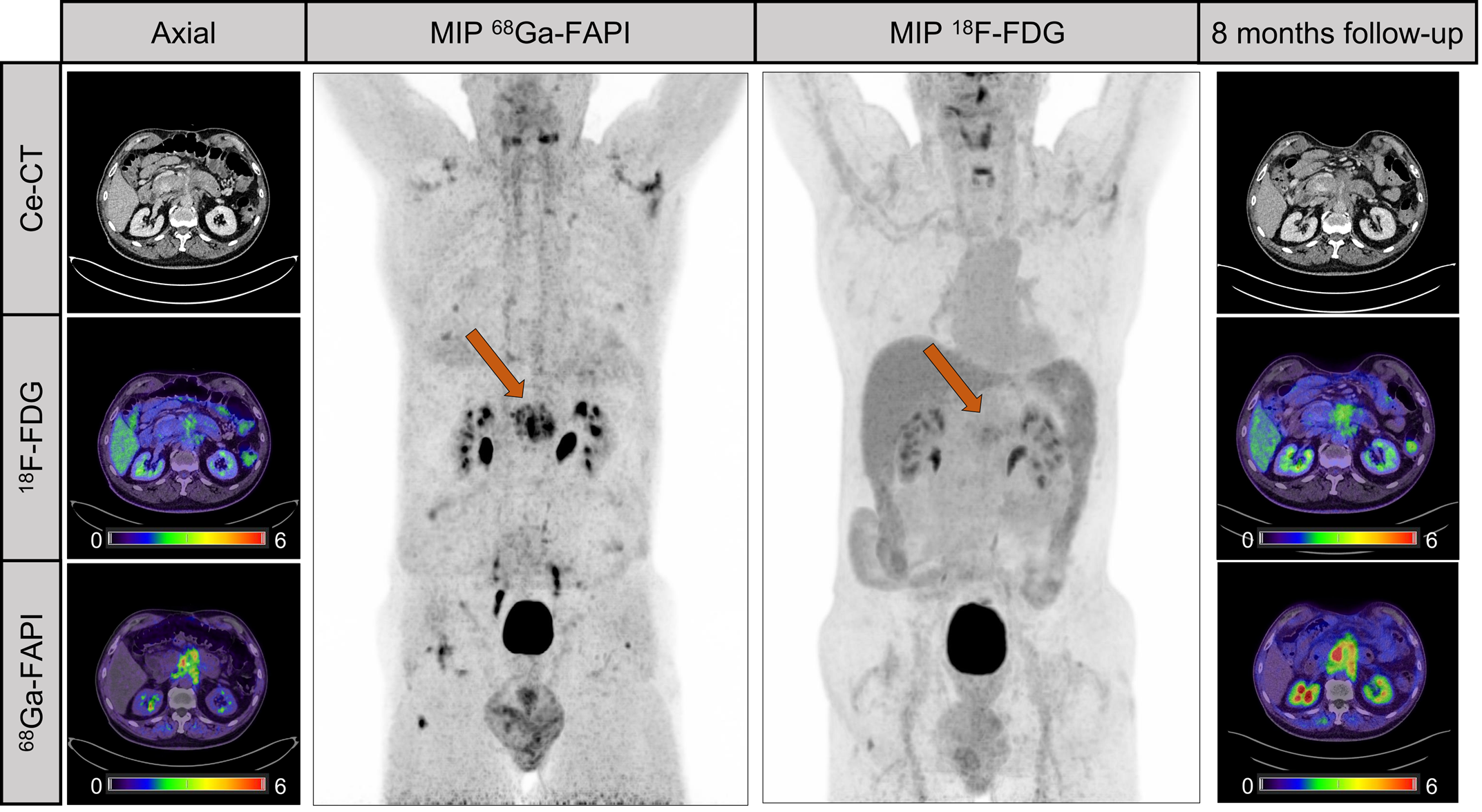 Ga-68 PET Improves Detection, Staging of Pancreatic Cancer | Applied ...