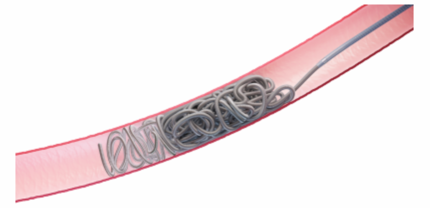 Terumo Launches New Peripheral Coil System in US | Applied Radiology