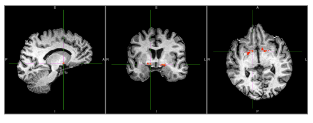 Brain Lesions in Former Football Players Linked to Vascular and Brain ...