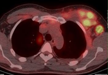 Practice Guideline for FES PET Imaging of Breast Cancer Published ...