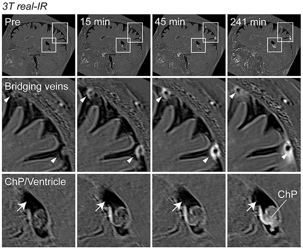 Direct Connection Between Brain and Dura Mater Discovered | Applied ...