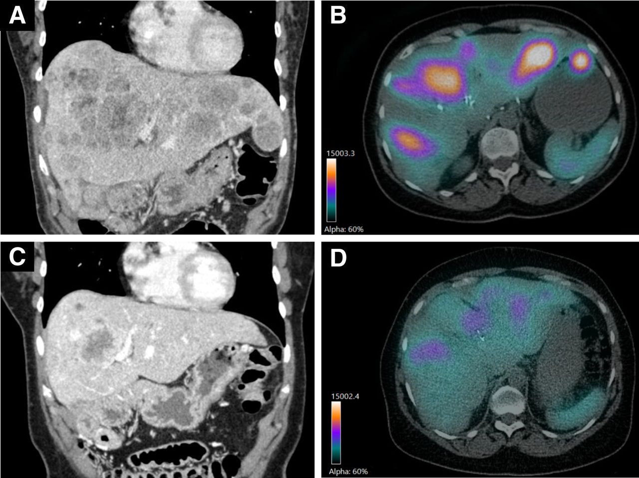 Radiopharmaceutical Therapy in Metastatic Insulinomas Controls Symptoms ...