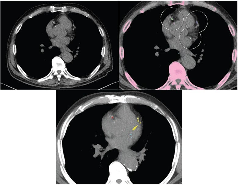 Study Assesses Coronary Artery Calcification During Low-Dose Lung ...