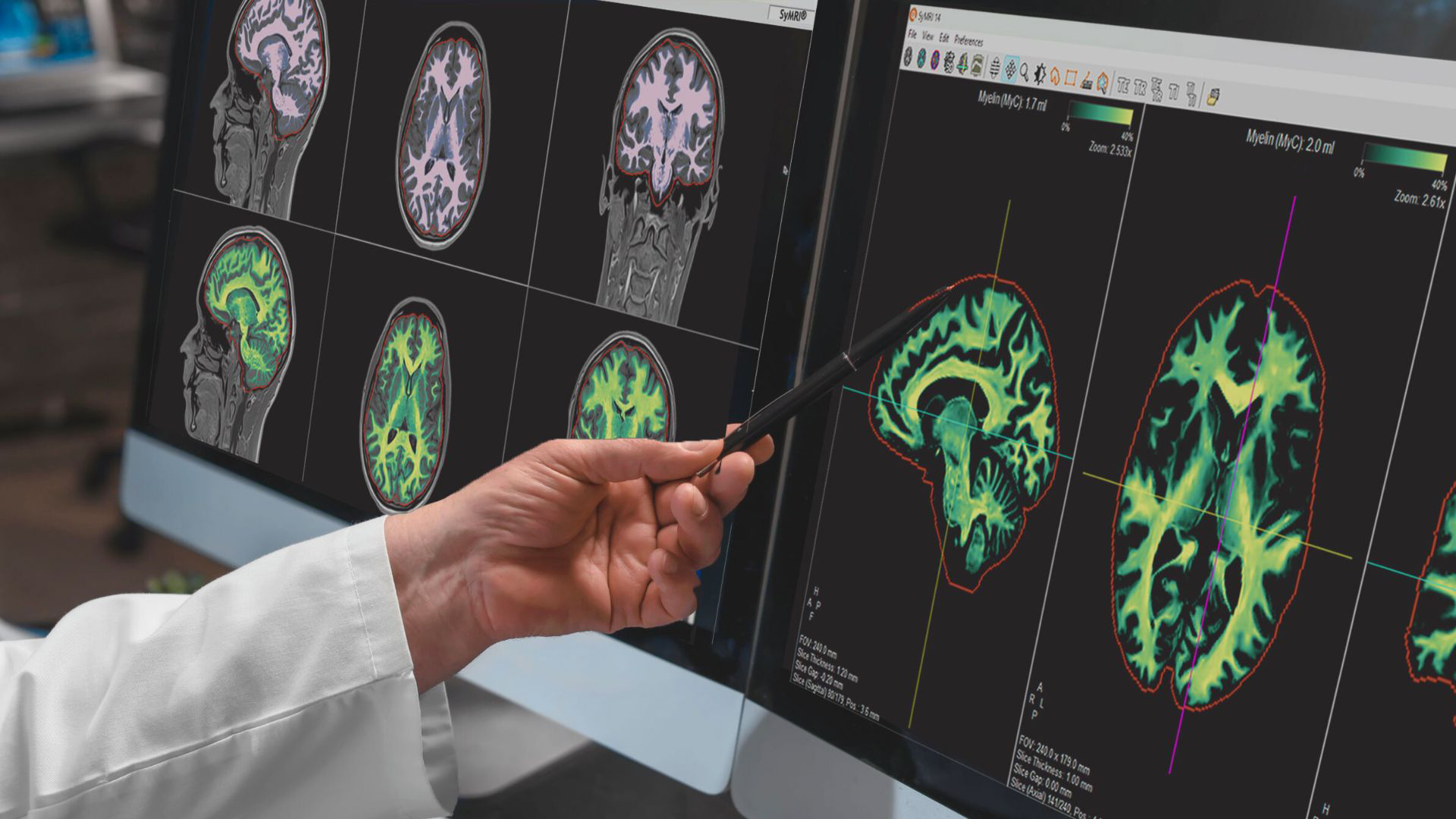 SyMRI 3D Receives FDA Clearance | Applied Radiology