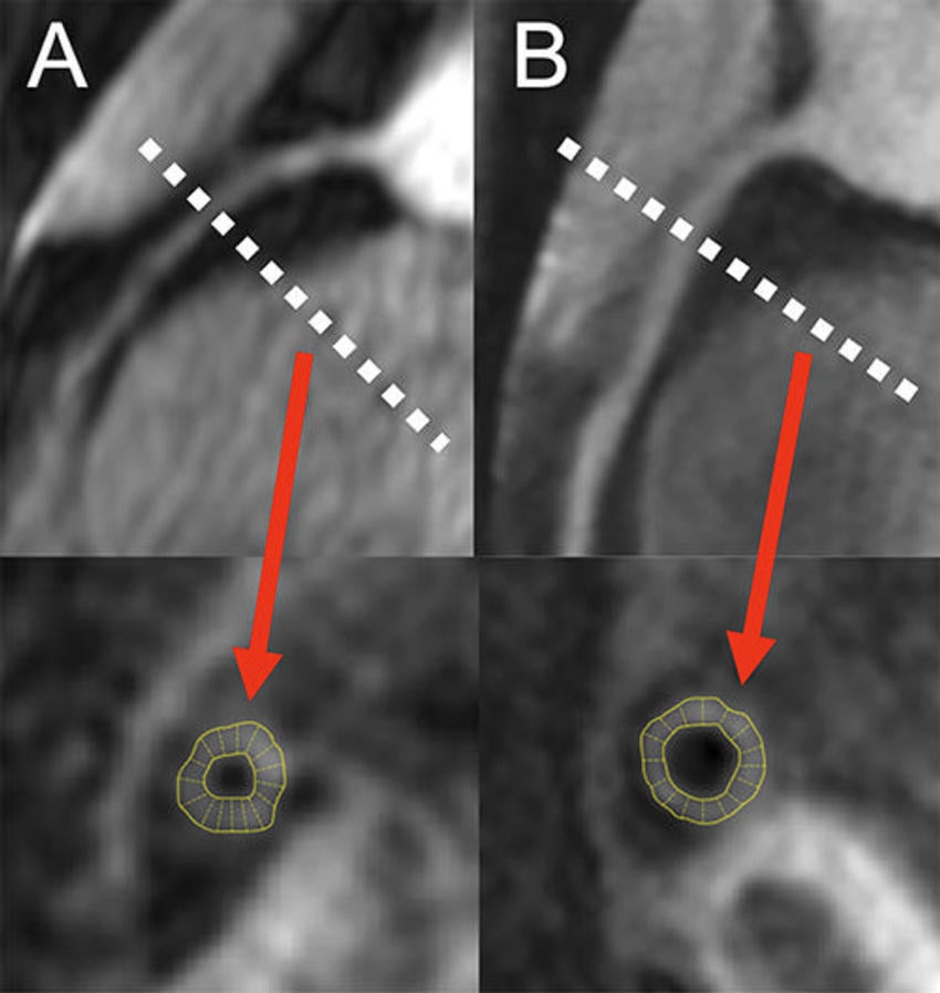 Impaired Heart Function, Early Coronary Disease Found in Asymptomatic ...