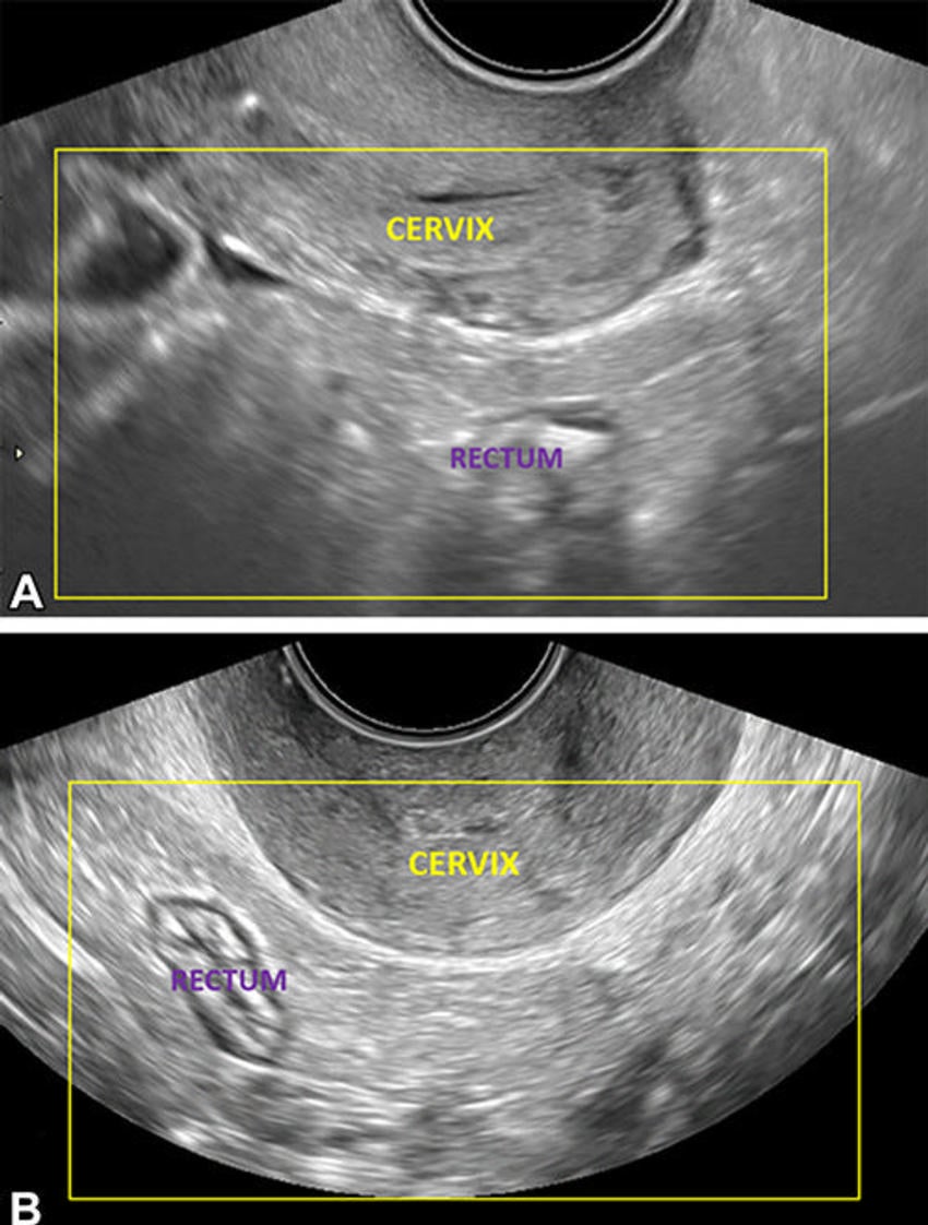 Consensus Statement Aims to Improve Diagnosis of Deep Endometriosis ...
