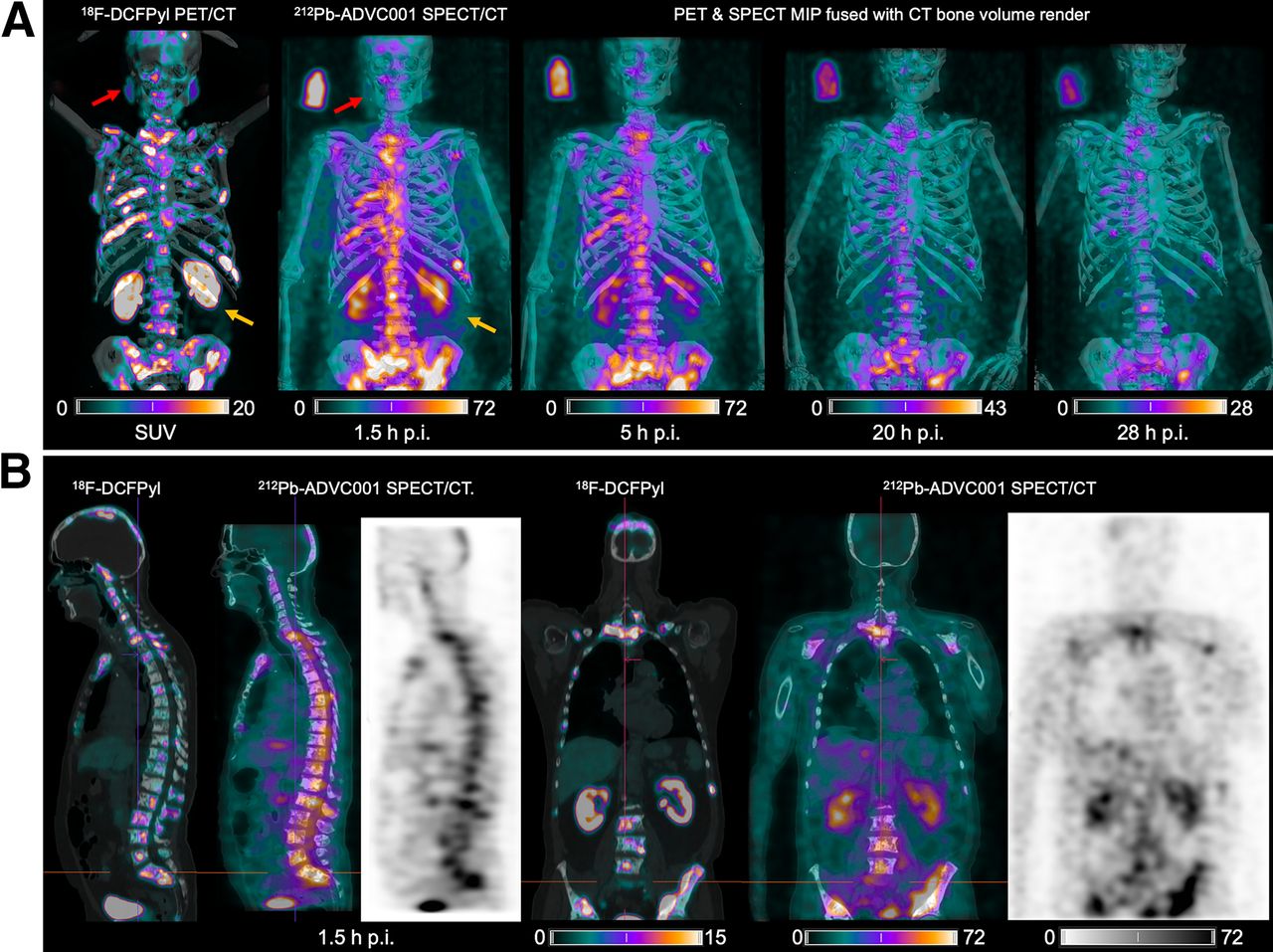 SPECT/CT Technique Detects Radiopharmaceutical Distribution in Prostate ...