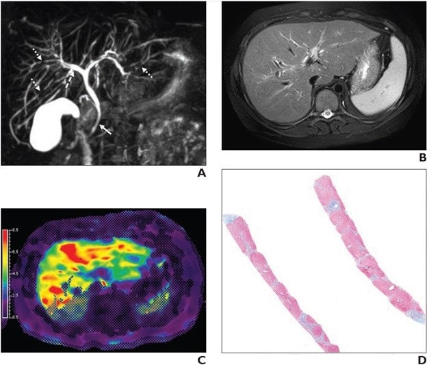 Study Supports Use of MRE for Monitoring Pediatric Autoimmune Liver ...