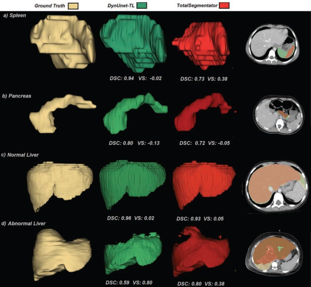 DL Development, Validation for Abdominal CT Organ Segmentation in ...
