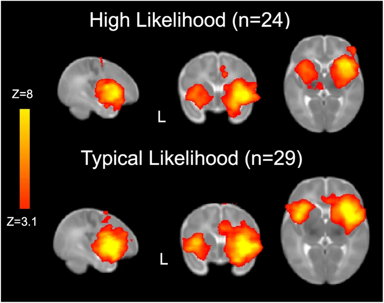 Infants at Familial Risk for Autism Have Distinct Brain Connectivity ...