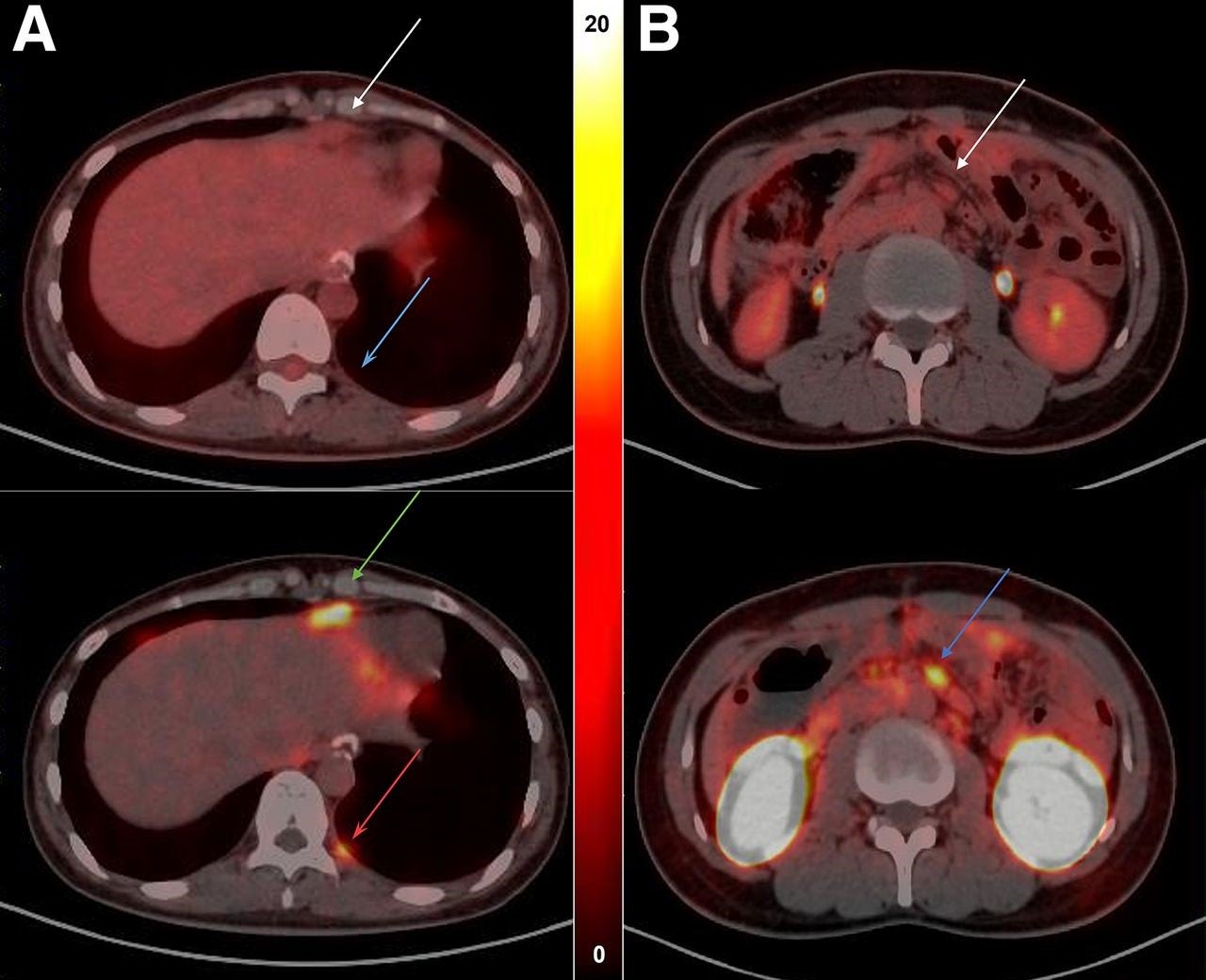 New Radiotracer Enables Same-Day Imaging of Gastrointestinal Cancer ...