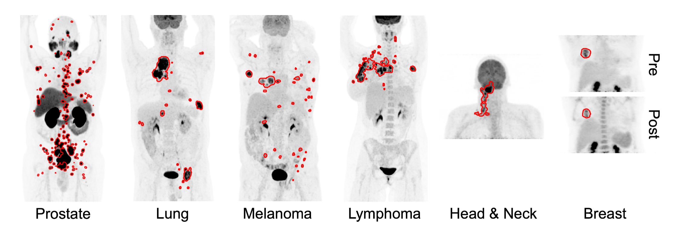 AI Tool Accurately Detects Six Different Cancer Types Using Whole-Body ...