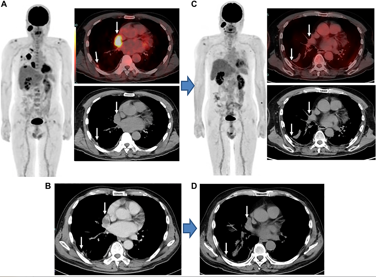 Study Compares FDG-PET/CT and CT for Treatment Evaluation in Patients ...