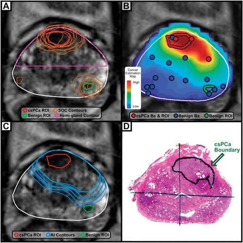 CMS Establishes National Payment for Innovative Prostate Cancer Mapping ...