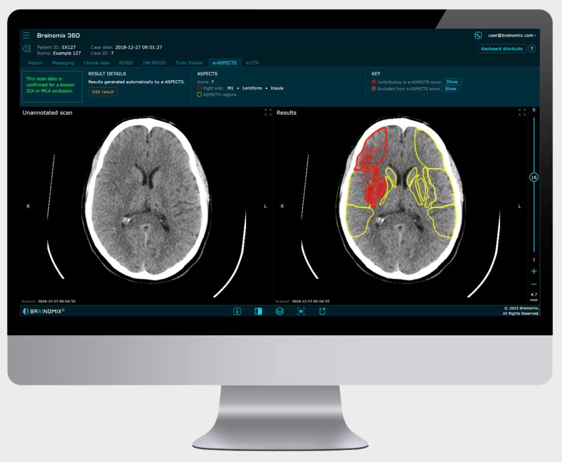 New Studies Validate Use of AI Technology Across US Stroke Networks ...