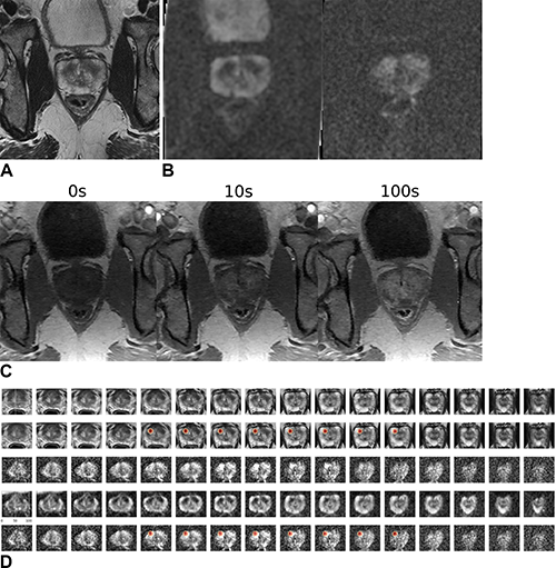 Fully Automated AI Model Detects Prostate Cancer on MRI | Applied Radiology