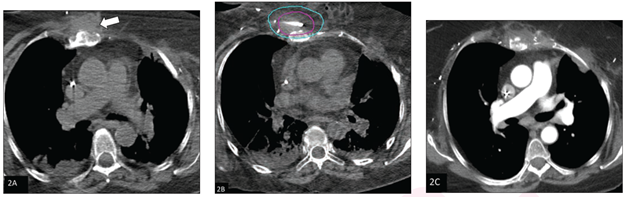 Cryoablation Effective, Safe for Metastatic Soft-Tissue Sarcoma in ...