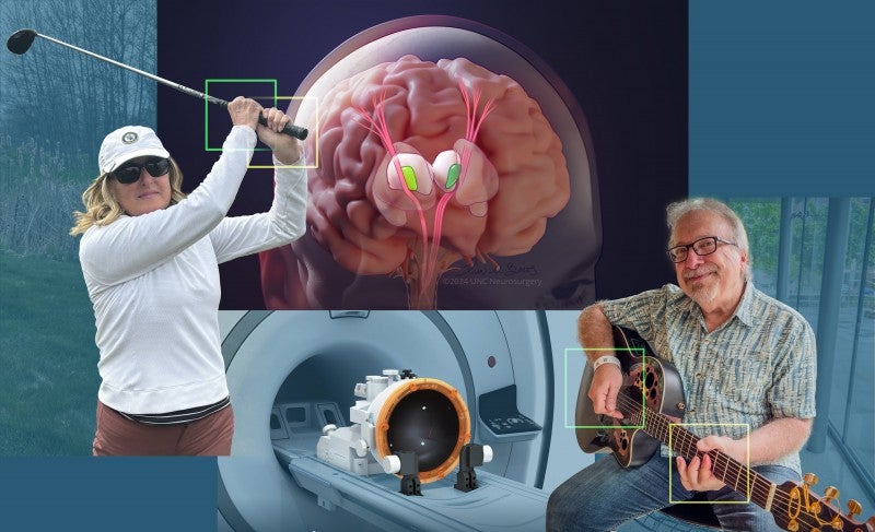 Bilateral Focused Ultrasound Safe, Effective for Patients With ...