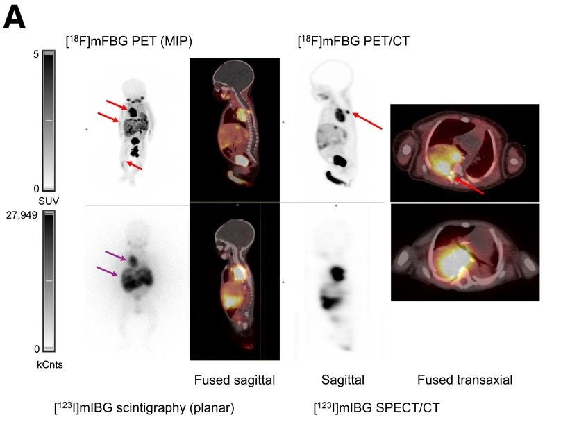 Molecular Imaging Technique Accurately Detects Neuroblastoma in ...