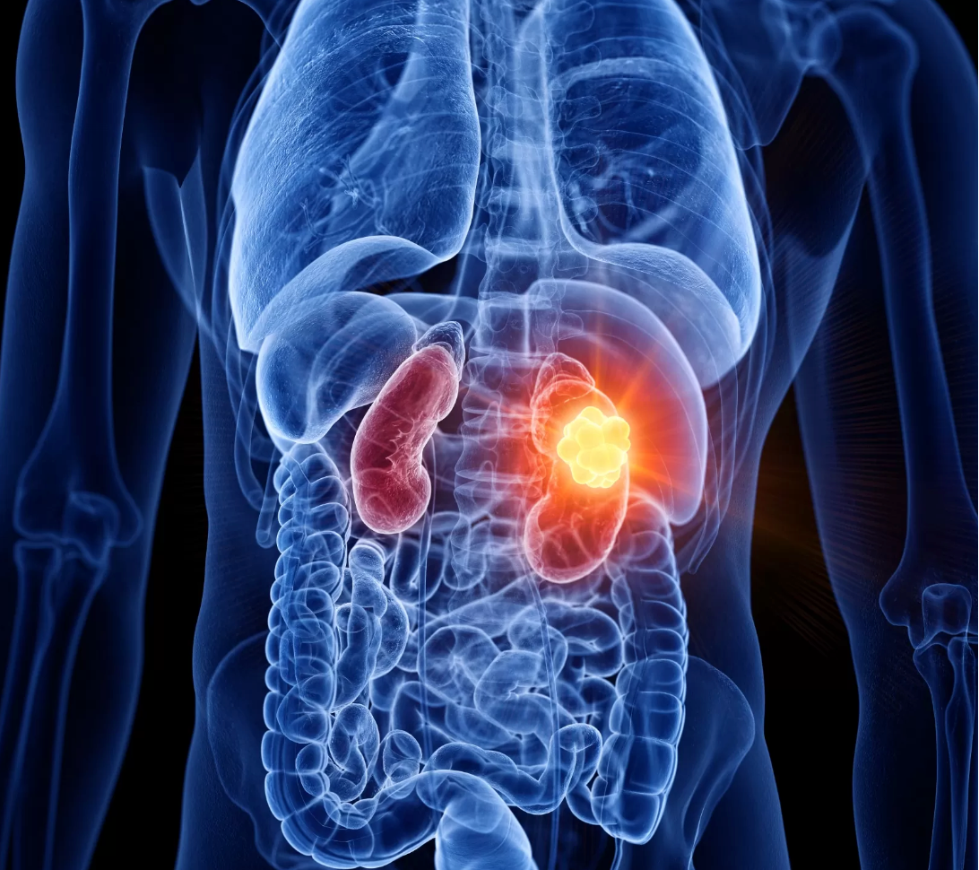 Telix Taps Cardinal Health for US Distribution of Kidney Cancer PET ...