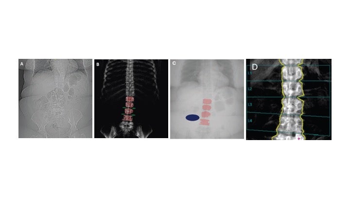 Photon-Counting Detector CT Shows Promise for Bone Density Data ...
