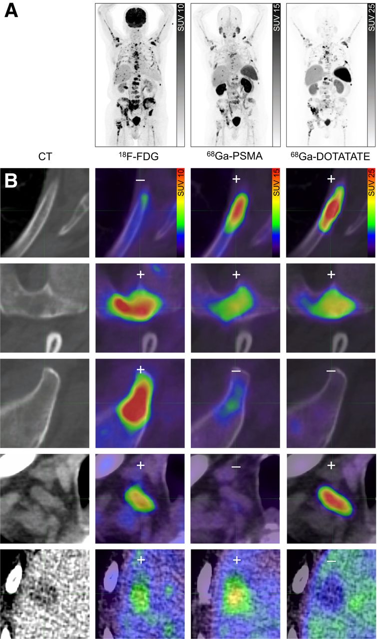 Multi-Tracer PET Personalizes Advanced Prostate Cancer Management ...
