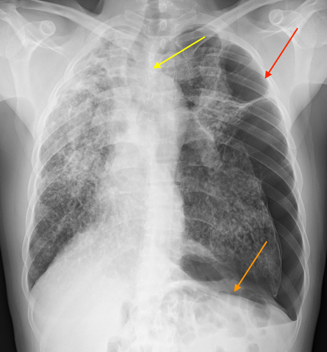 Serious Lung Disease Found in Countertop Workers | Applied Radiology