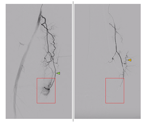 Genicular Artery Embolization Relieves Knee Arthritis | Applied Radiology