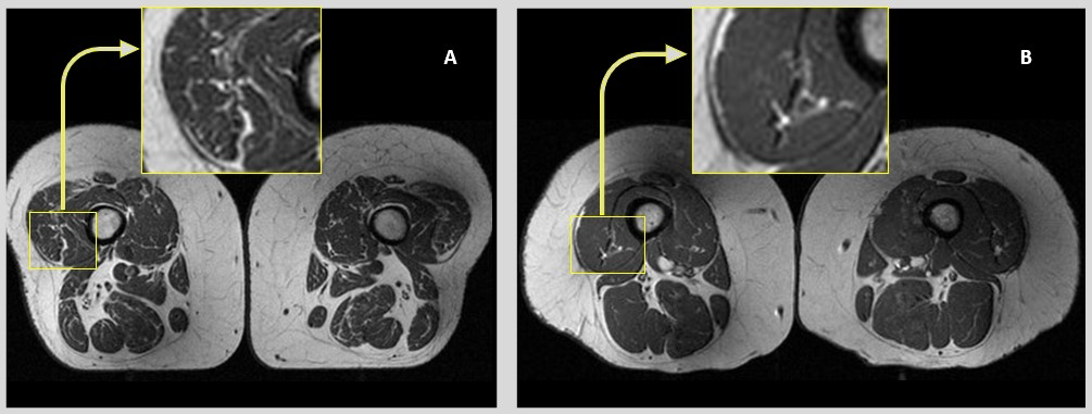 High Ultra-Processed Food Diet Impacts Muscle Quality | Applied Radiology