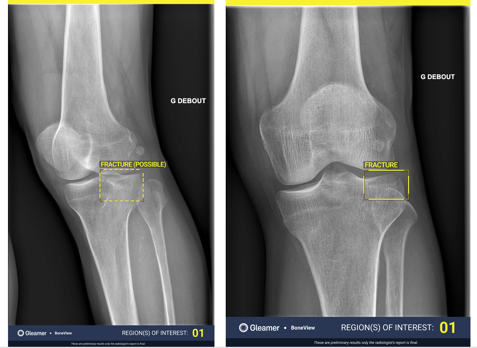 Konica Minolta, Gleamer Partner on AI for X-ray | Applied Radiology