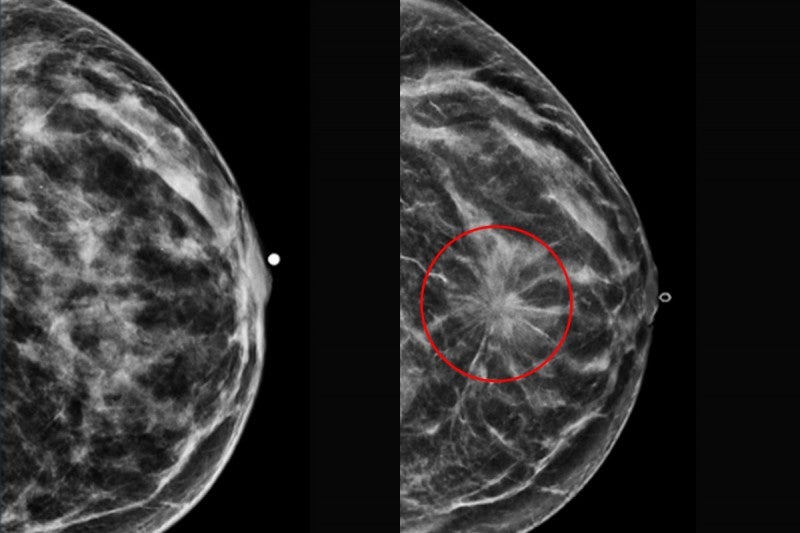 AI Analysis of Multiple Mammograms Improves Breast Cancer Risk ...