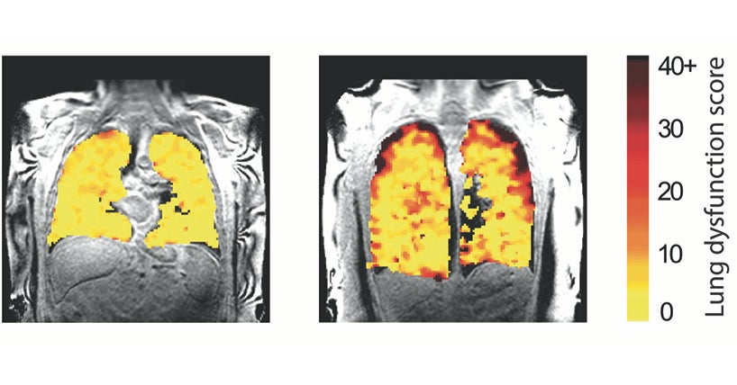 MRI Method Shows Impact of Lung Treatment in Patients | Applied Radiology